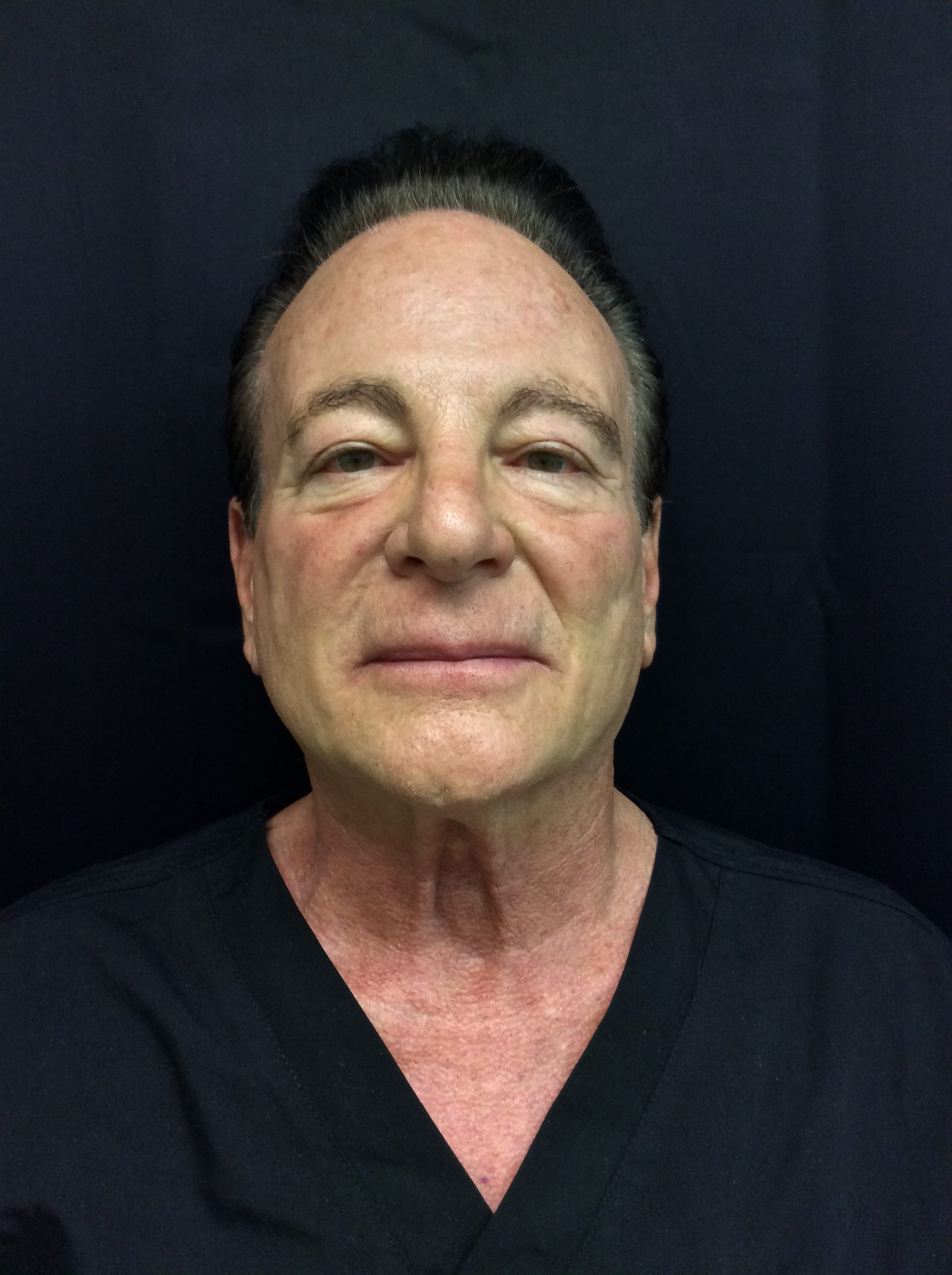 When A Plastic Surgeon Has Plastic Surgery - Yale Kadesky MD