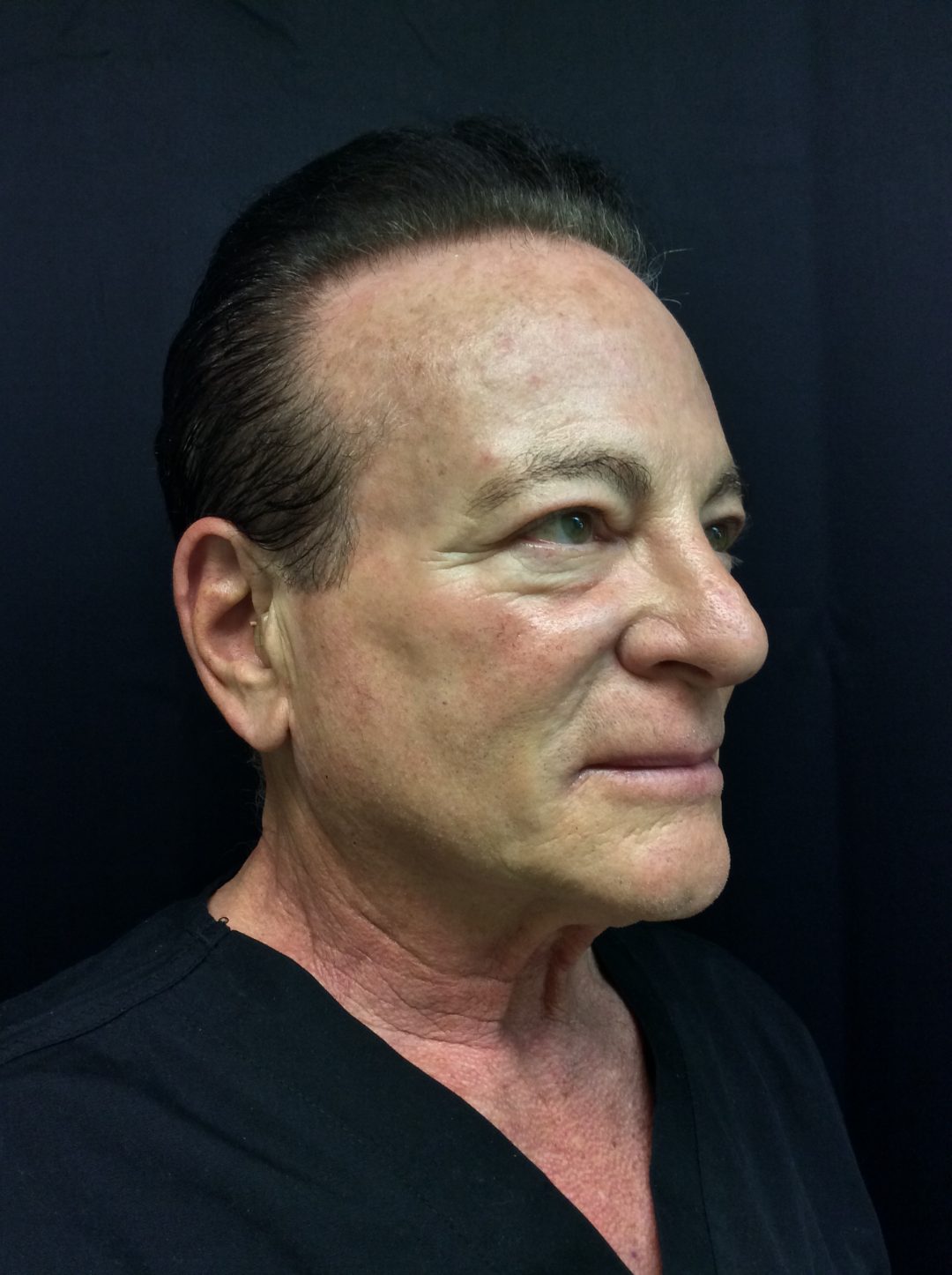 When a Plastic Surgeon gets Plastic Surgery Part III - Yale Kadesky MD