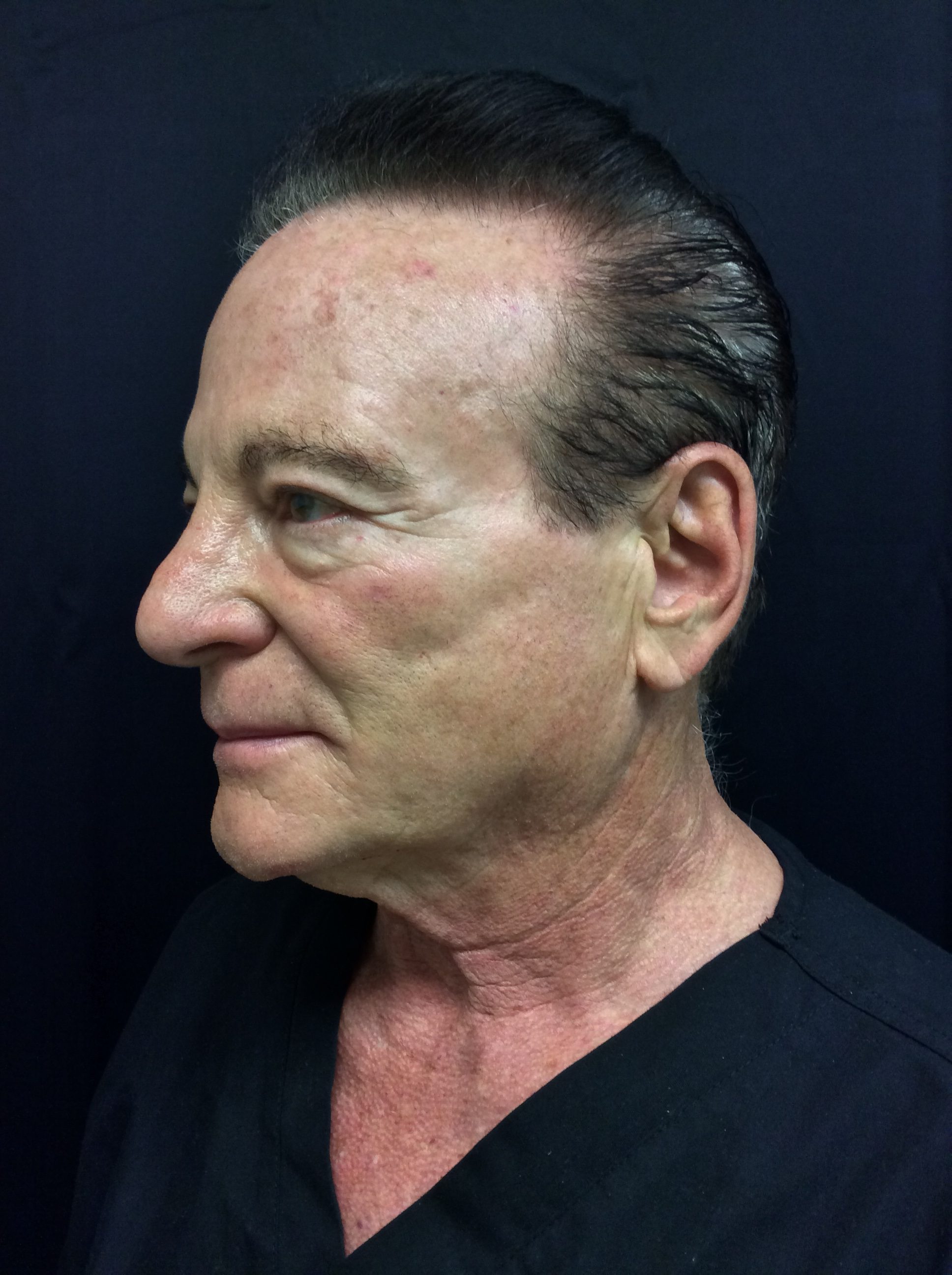 When A Plastic Surgeon Has Plastic Surgery - Yale Kadesky MD