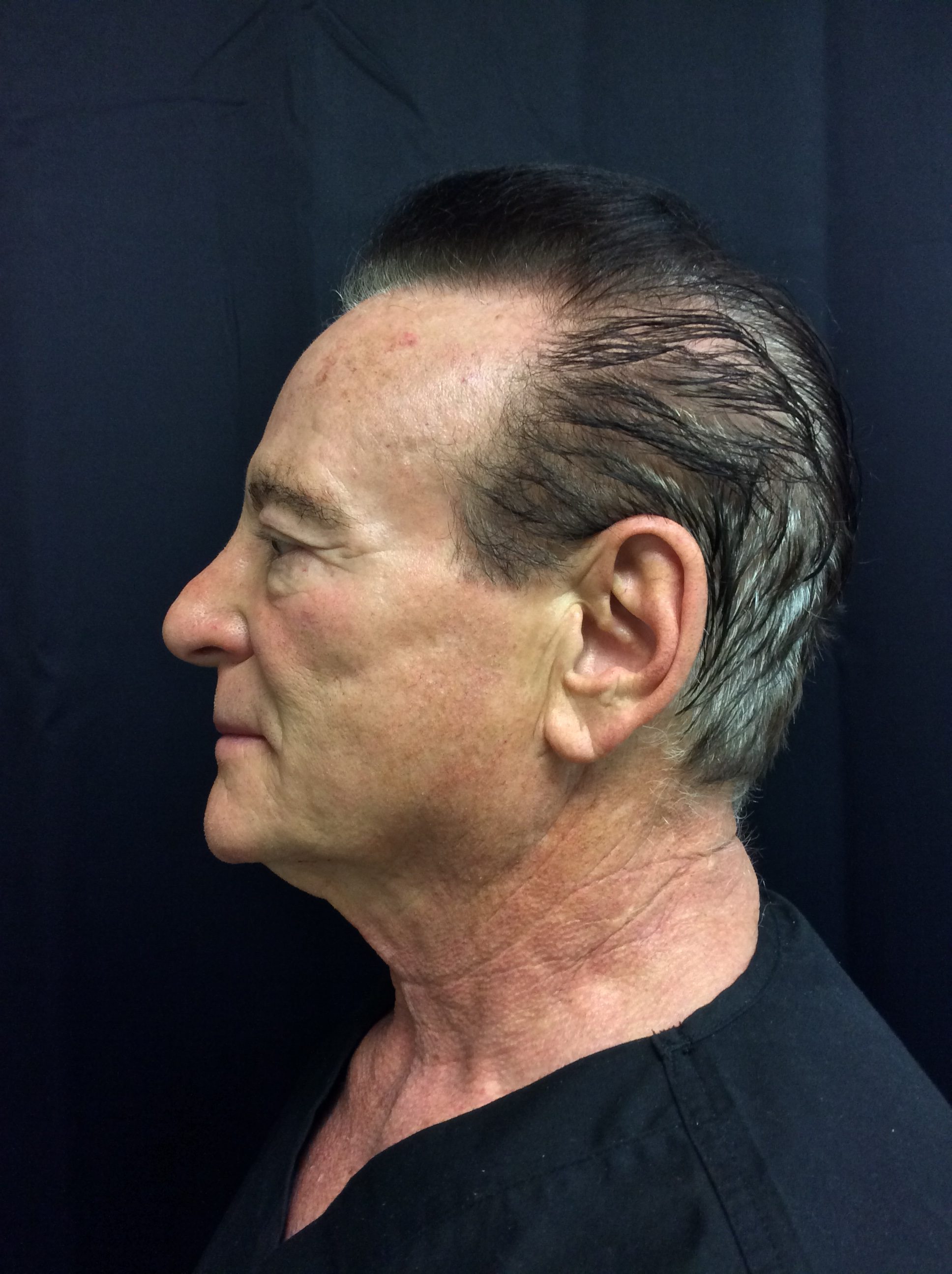 When A Plastic Surgeon Has Plastic Surgery - Yale Kadesky MD