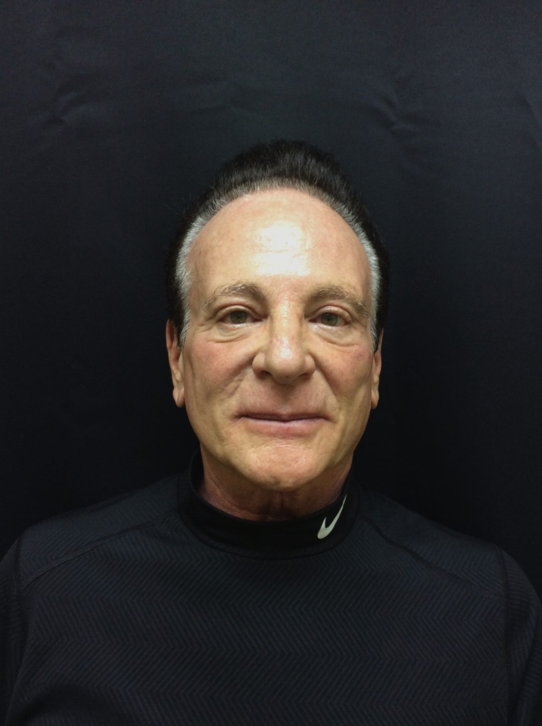 When a Plastic Surgeon gets Plastic Surgery Part III - Yale Kadesky MD