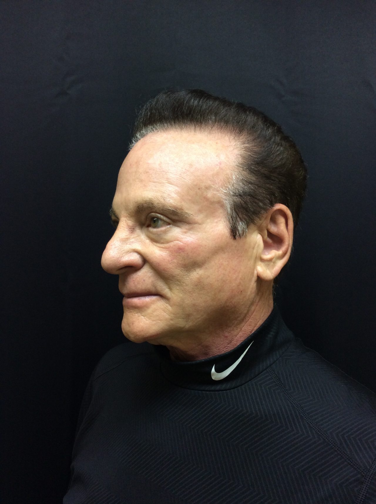 When a Plastic Surgeon gets Plastic Surgery Part III - Yale Kadesky MD