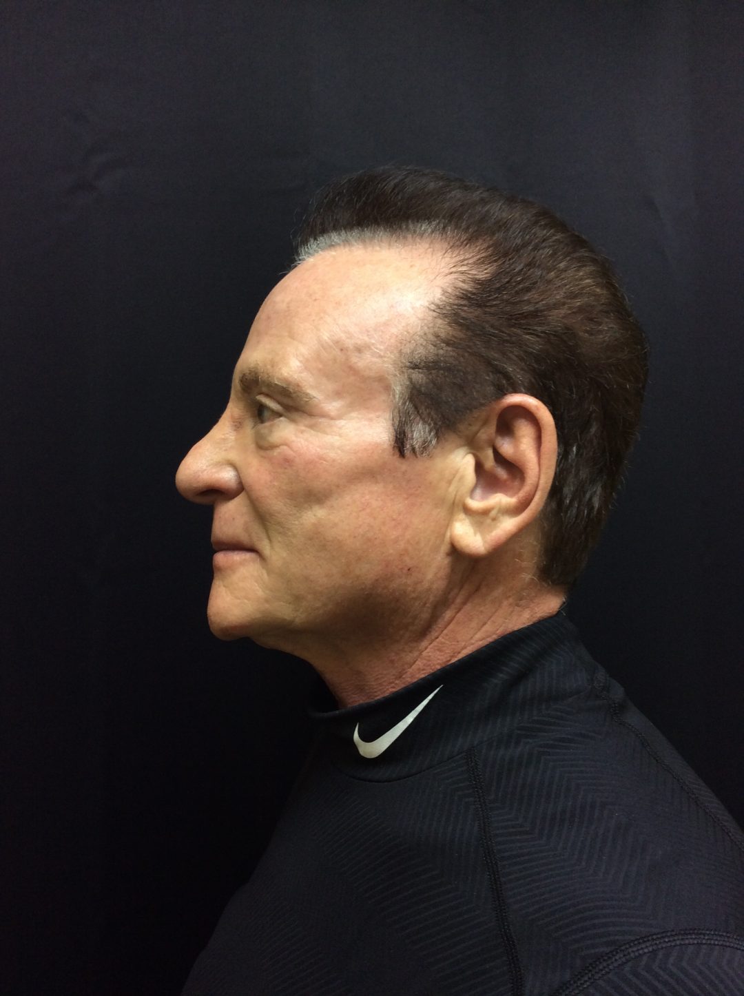 When a Plastic Surgeon gets Plastic Surgery Part III - Yale Kadesky MD